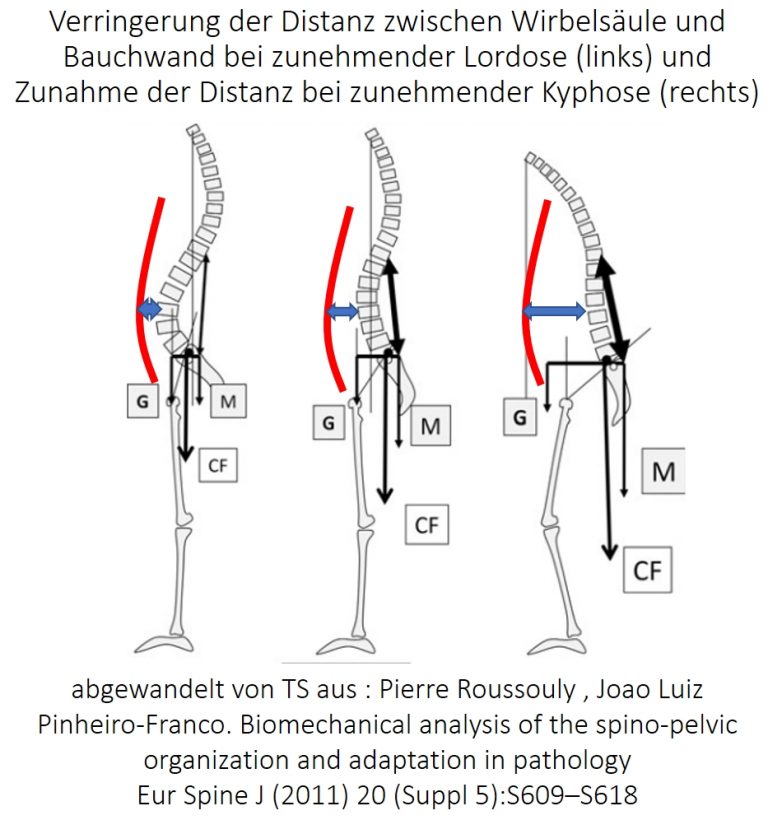 The extent of lordosis is described by Euler’s laws, Euler case 2).