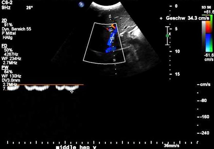 Diaphragmatic compression of the hepatic veins