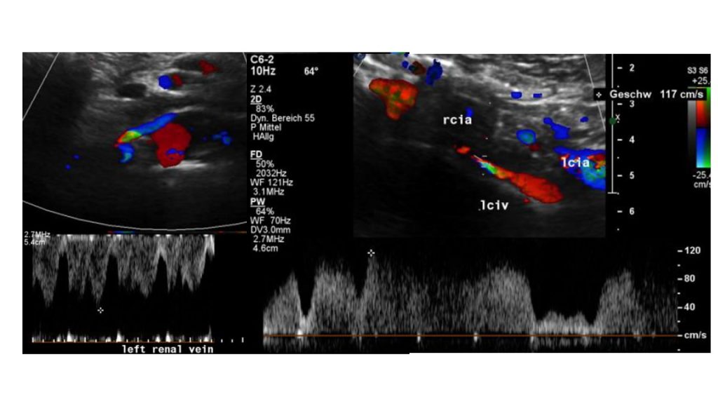 Detection of a new compression syndrome : Bilateral compression of the ...
