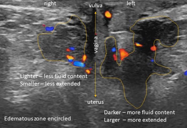 Genital and sexual symptoms of vascular compression syndromes – patient ...