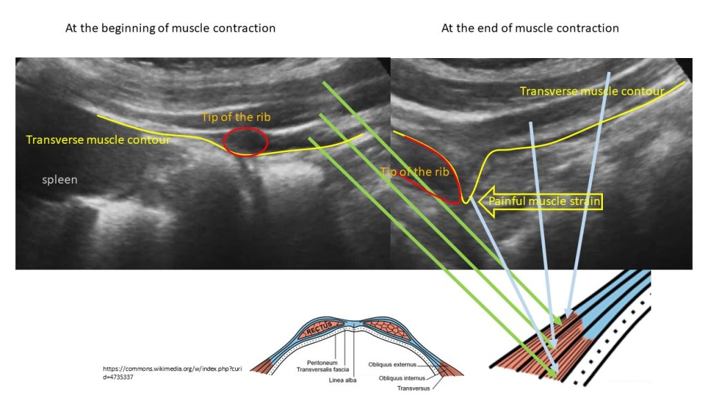 Abdominal pain due to liver compression in slipping rib syndrome in an ...