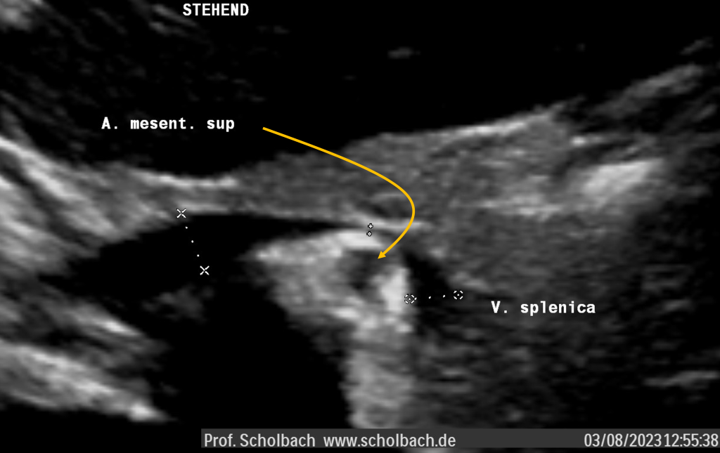 Posture dependent left flank / thoracic / lumbar pain – a new ...