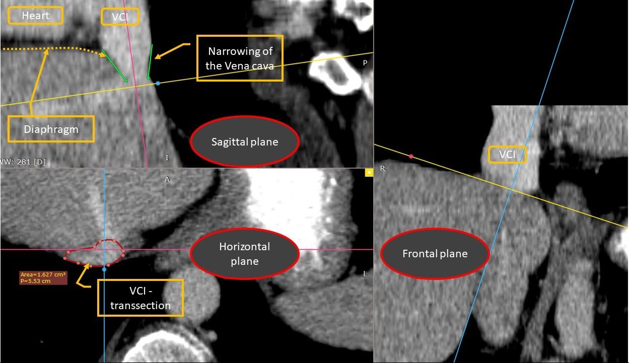 Diaphragmatic compression of the liver veins with hepatic and ...