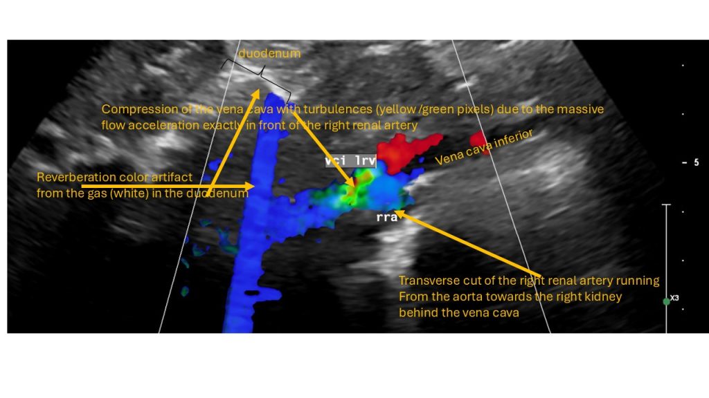 compression of the vena cava by the right renal artery Post-prandial ...